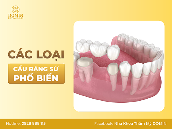 Các loại cầu răng sứ phổ biến hiện nay