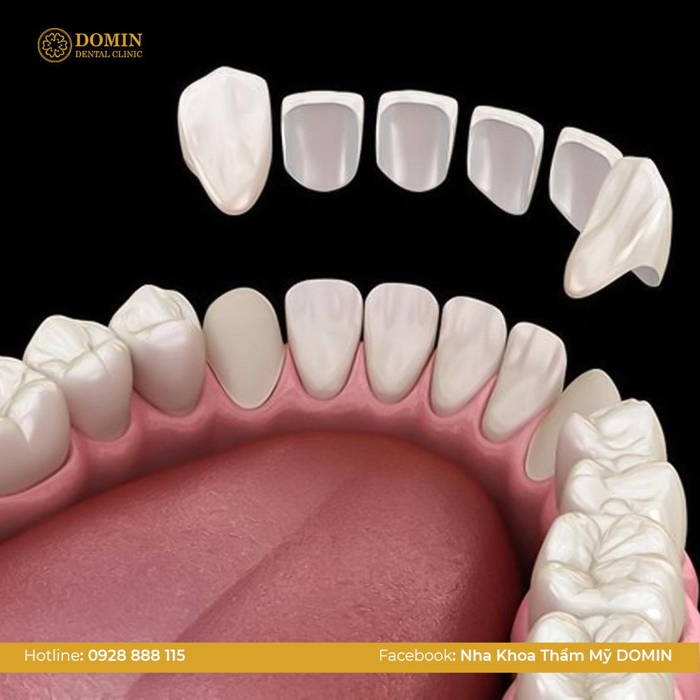 Giải đáp thắc mắc: “Dán sứ veneer có bền không?”