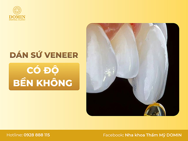 Giải đáp thắc mắc: “Dán sứ veneer có bền không?”