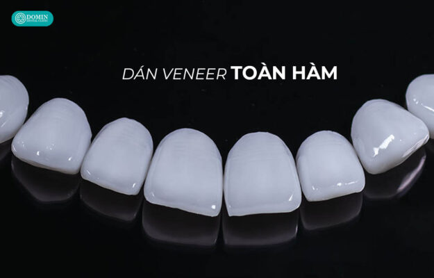 Dán Sứ Veneer Toàn Hàm: Ai Nên Áp Dụng? Chi Phí Bao Nhiêu?