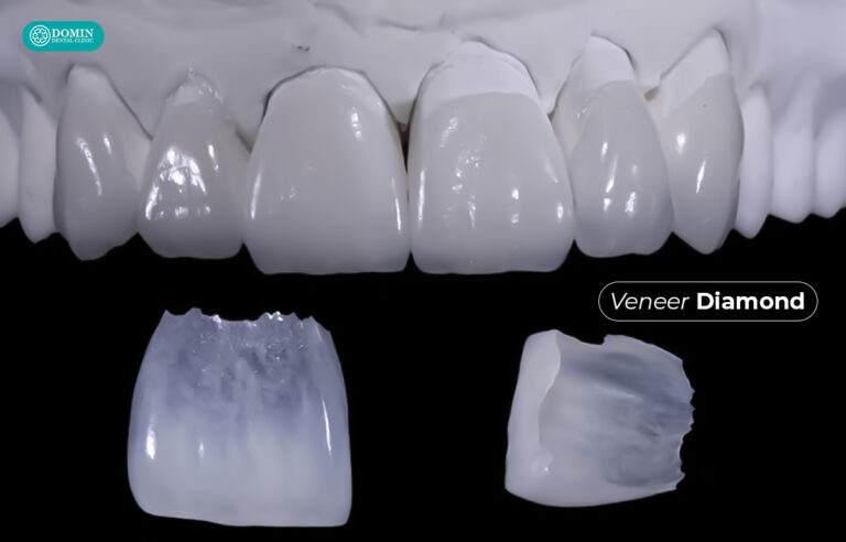 Dán Sứ Veneer Diamond Có Tốt Không? 6 Ưu Điểm Chớ Bỏ Qua
