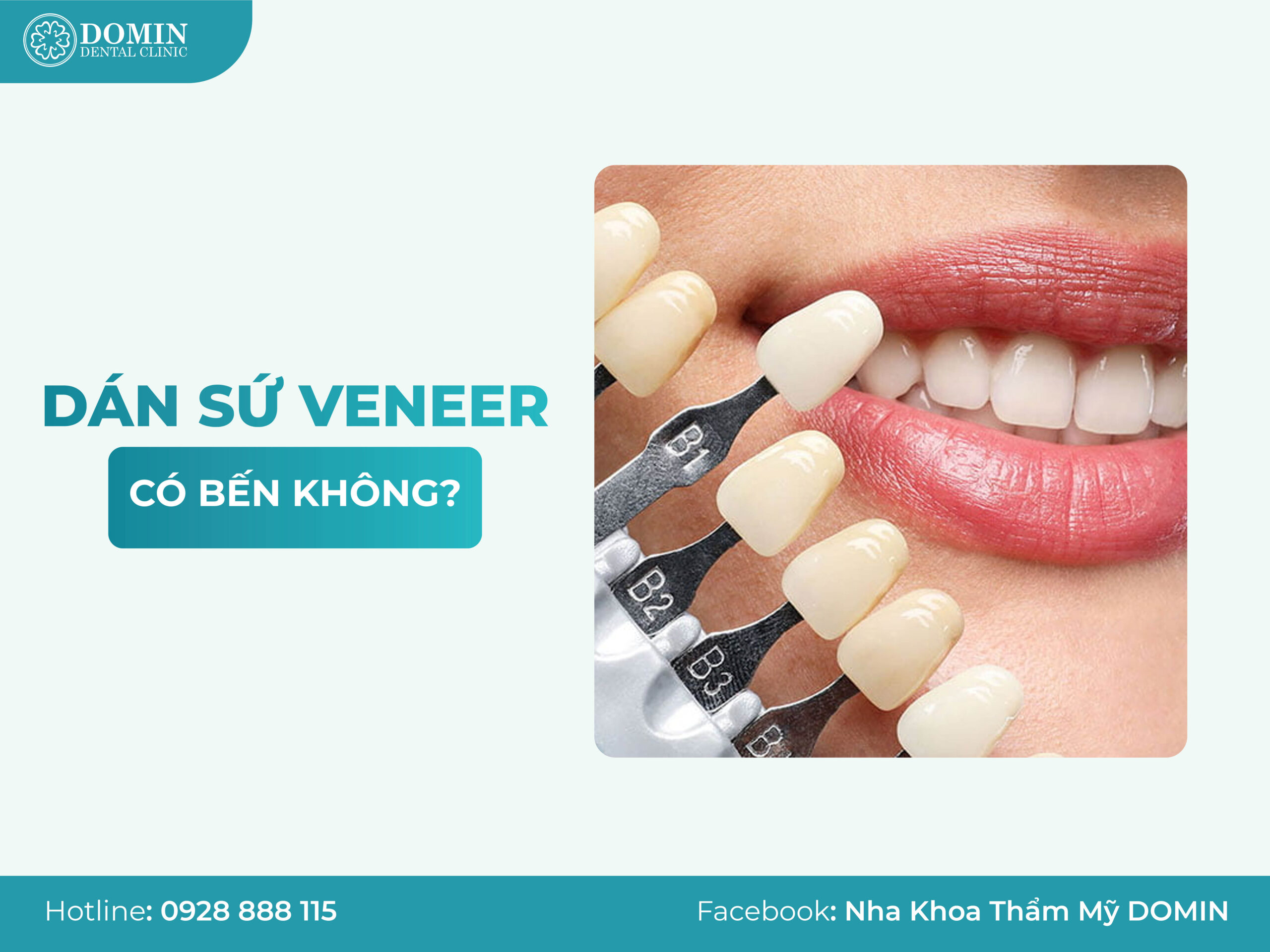 Dán Sứ Có Bền Không? Cách Giữ Mặt Dán Veneer Bền Lâu