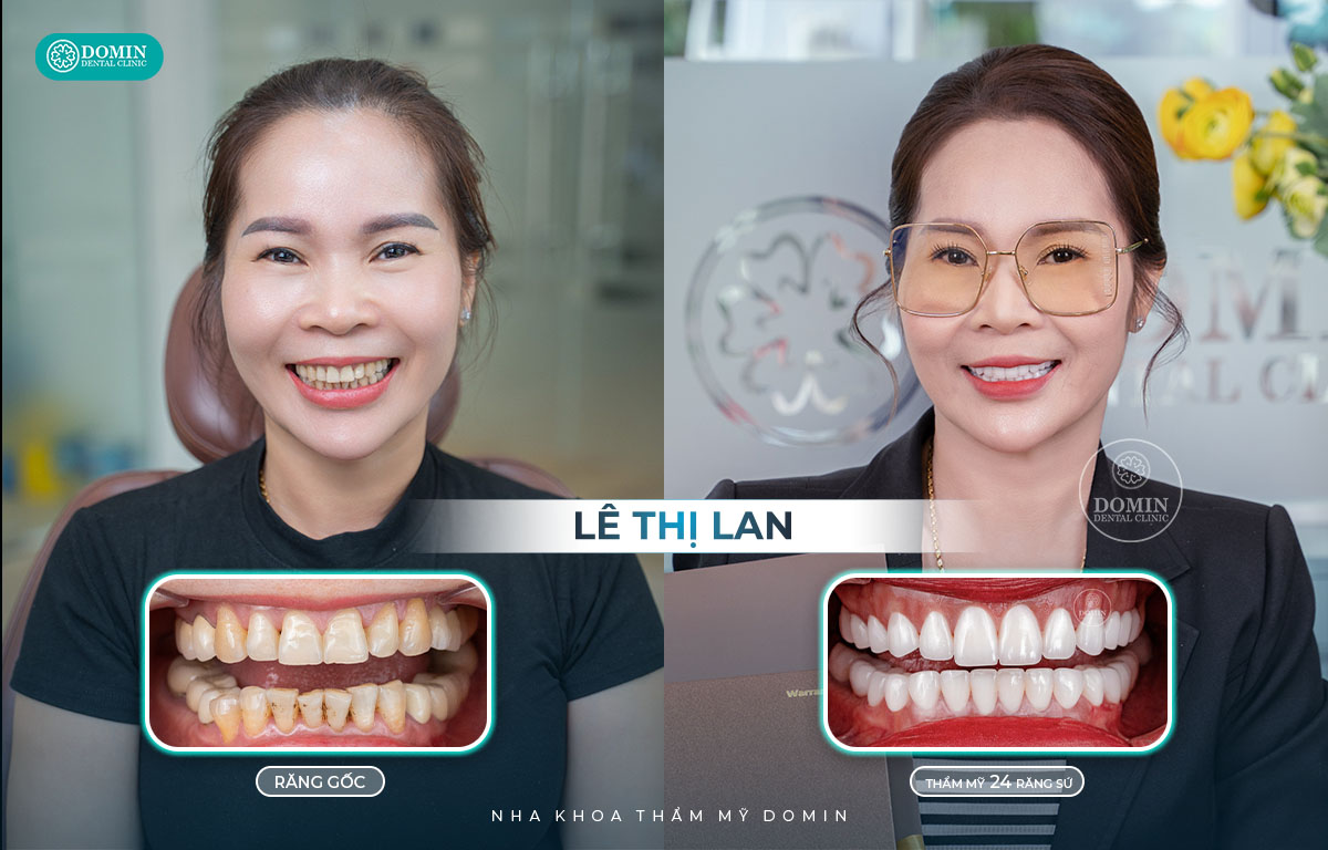 Việt Kiều Nói Gì Khi Dán Sứ Veneer Tại Nha Khoa Domin? Review