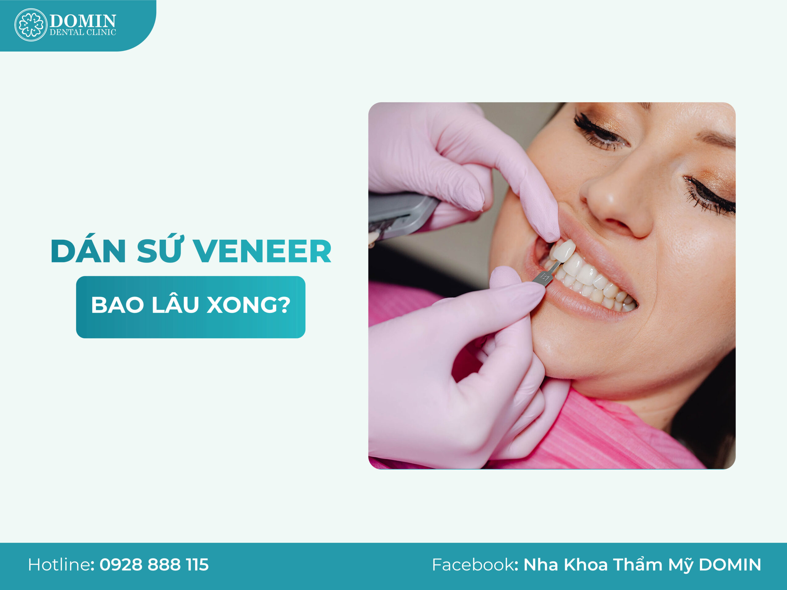 Dán Sứ Veneer Bao Lâu Thì Xong? Cụ Thể Thời Gian Thực Tế